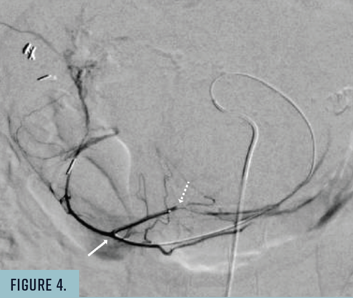 Case Report: Transarterial Embolization of Neuroendocrine Tumor Liver ...