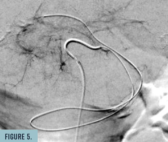 Case Report: Transarterial Embolization of Neuroendocrine Tumor Liver ...
