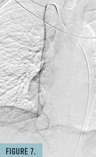Case Report: Transarterial Embolization of Neuroendocrine Tumor Liver ...