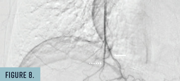 Case Report: Transarterial Embolization of Neuroendocrine Tumor Liver ...