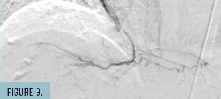 Case Report: Transarterial Embolization of Neuroendocrine Tumor Liver ...