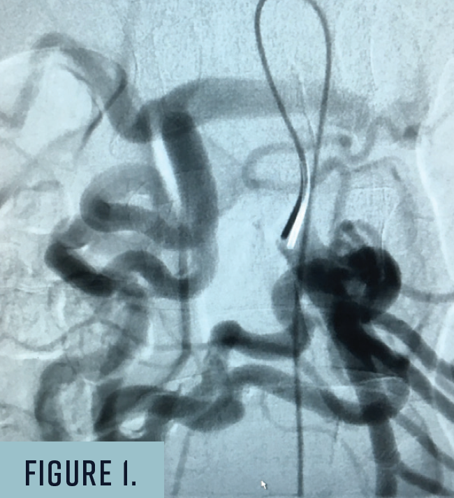 Case Report: Yttrium-90 Mapping Via a Radial Approach in a Patient With ...