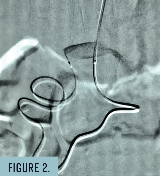Case Report: Yttrium-90 Mapping Via a Radial Approach in a Patient With ...