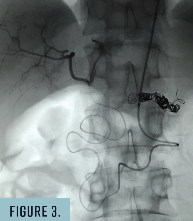 Case Report: Yttrium-90 Mapping Via a Radial Approach in a Patient With ...