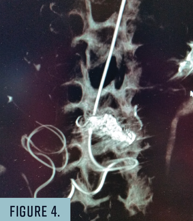 Case Report: Yttrium-90 Mapping Via a Radial Approach in a Patient With ...