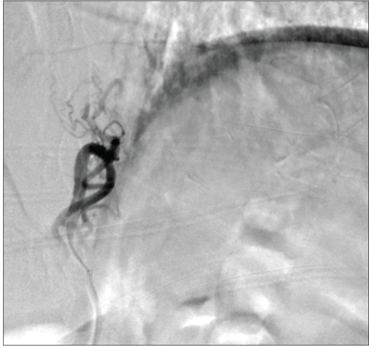 Bariatric Embolization: Are Patients Actually Losing Weight ...