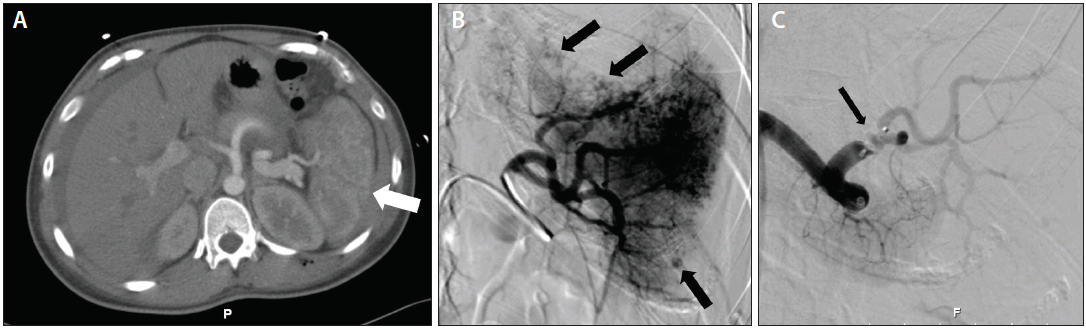 Splenic Artery Embolization: Proximal or Distal? - Endovascular Today