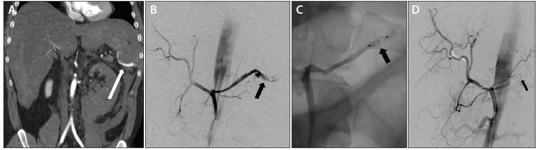 Splenic Artery Embolization: Proximal or Distal? - Endovascular Today