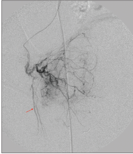 A US Perspective: PAE: Is It Ready for Prime Time? - Endovascular Today