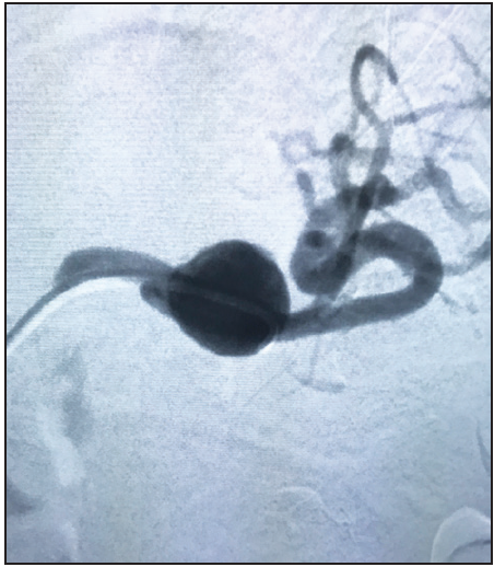 Ruby® Coil and POD® System: A Coil Platform for Fast and Easy ...