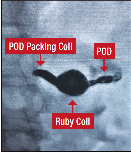 Ruby® Coil and POD® System: A Coil Platform for Fast and Easy Embolization - Endovascular Today