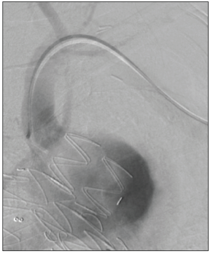 Ruby® Coil and POD® System: A Coil Platform for Fast and Easy ...