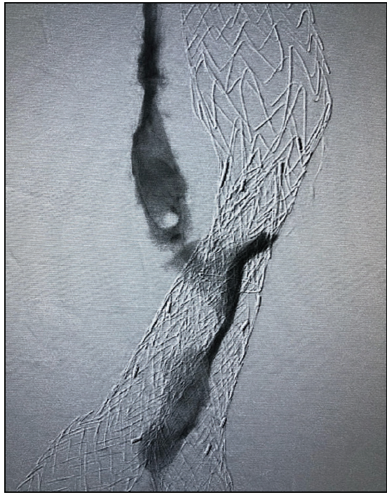 Ruby® Coil and POD® System: A Coil Platform for Fast and Easy ...