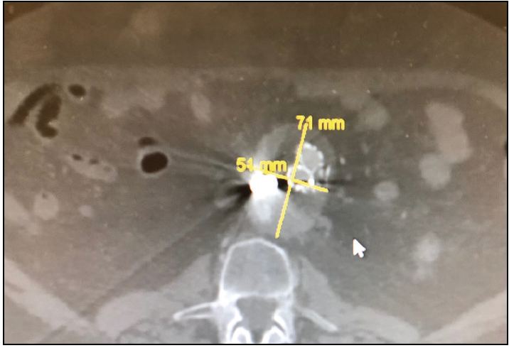 Ruby® Coil and POD® System: A Coil Platform for Fast and Easy ...