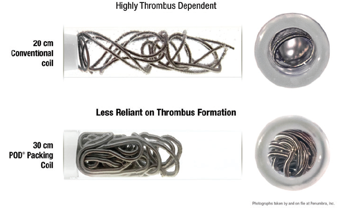 Ruby® Coil and POD® System: A Coil Platform for Fast and Easy Embolization - Endovascular Today