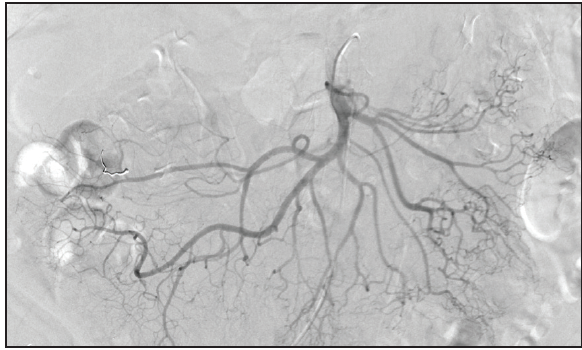 Ruby® Coil and POD® System: A Coil Platform for Fast and Easy ...