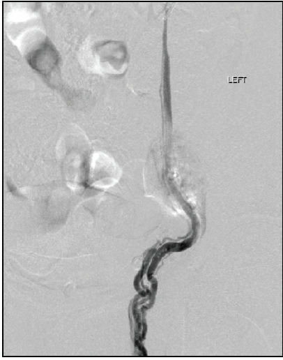 Ruby® Coil and POD® System: A Coil Platform for Fast and Easy ...
