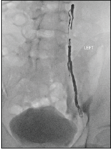 Ruby® Coil and POD® System: A Coil Platform for Fast and Easy ...