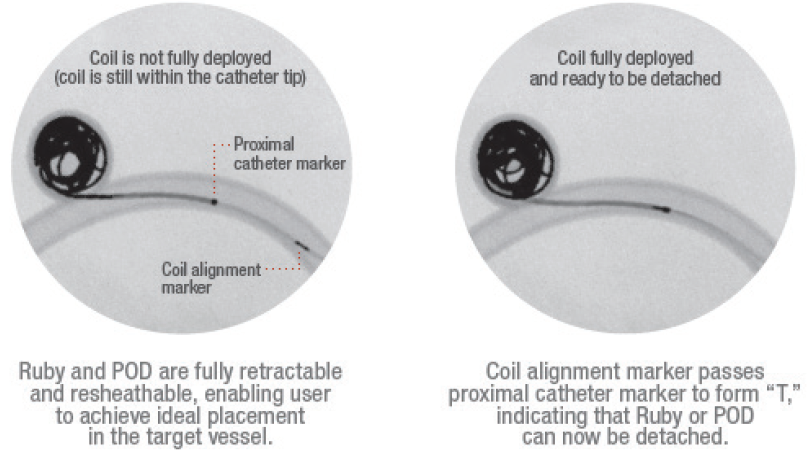 Ruby® Coil and POD® System: A Coil Platform for Fast and Easy ...