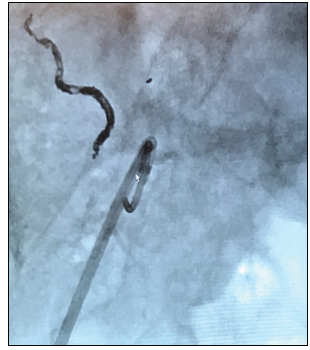 Ruby® Coil and POD® System: A Coil Platform for Fast and Easy ...