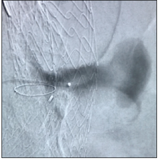 Ruby® Coil and POD® System: A Coil Platform for Fast and Easy ...