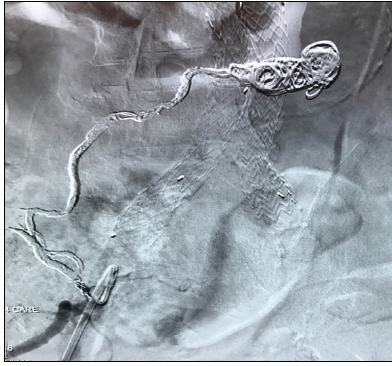 Ruby® Coil and POD® System: A Coil Platform for Fast and Easy ...