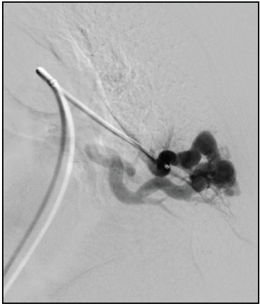 Ruby® Coil and POD® System: A Coil Platform for Fast and Easy ...