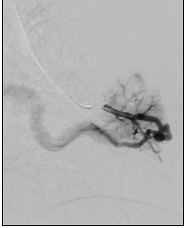Ruby® Coil and POD® System: A Coil Platform for Fast and Easy ...