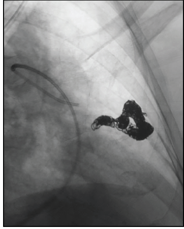 Ruby® Coil and POD® System: A Coil Platform for Fast and Easy ...