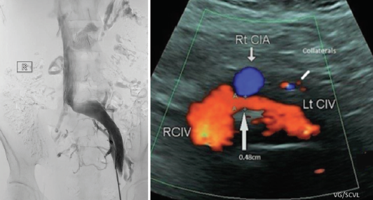 Our Protocol for Transabdominal Pelvic Vein Duplex Ultrasound ...