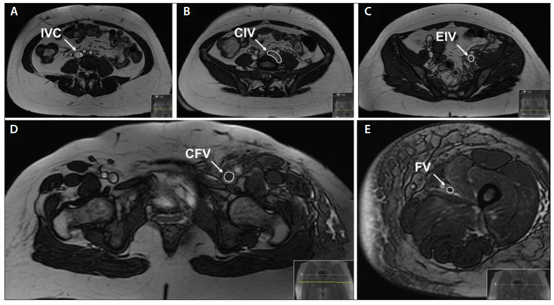 Diagnosing Deep Venous Disease Through Optimized Imaging: Magnetic ...