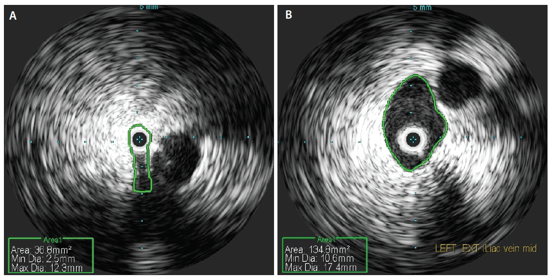 Diagnosing Venous Disease With IVUS: How I Do It - Endovascular Today