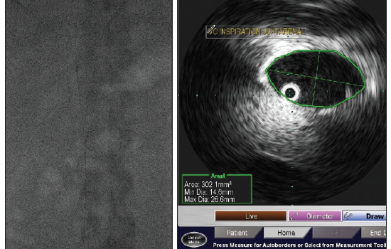 Tips and Tricks for Venous IVUS Success - Endovascular Today