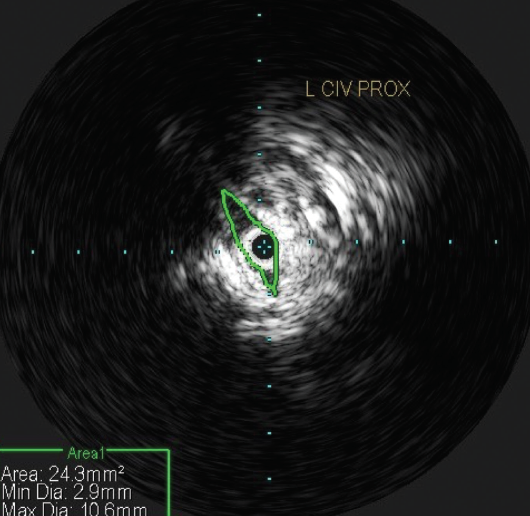 Tips and Tricks for Venous IVUS Success - Endovascular Today