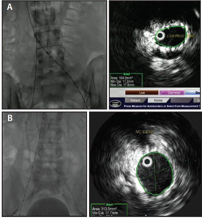 Tips and Tricks for Venous IVUS Success - Endovascular Today