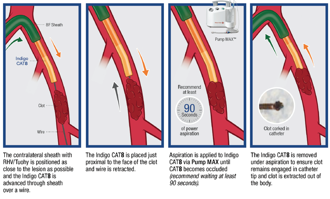 Indigo® System for Thromboembolic Disease - Endovascular Today