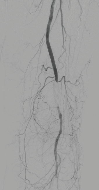 Indigo® System for Thromboembolic Disease - Endovascular Today