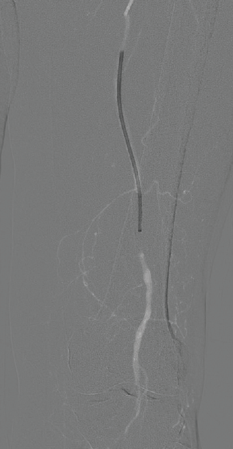 Indigo® System for Thromboembolic Disease - Endovascular Today