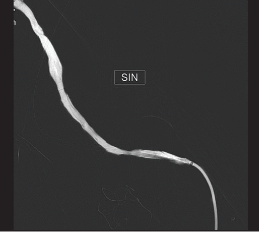 Indigo® System for Thromboembolic Disease - Endovascular Today