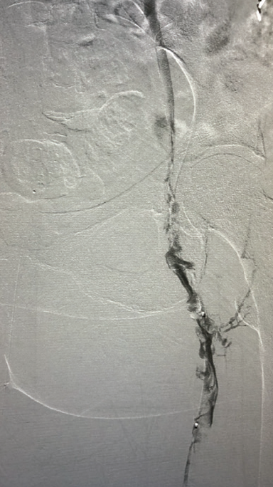 Indigo® System for Thromboembolic Disease - Endovascular Today