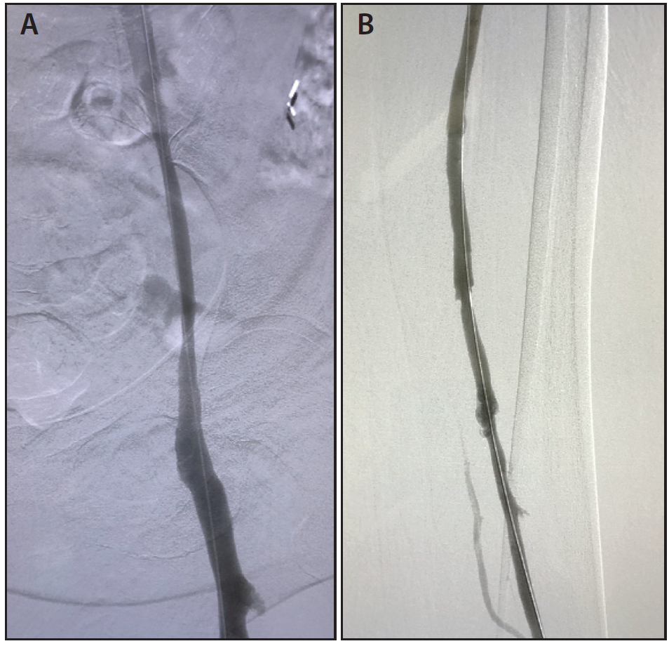Indigo® System for Thromboembolic Disease - Endovascular Today