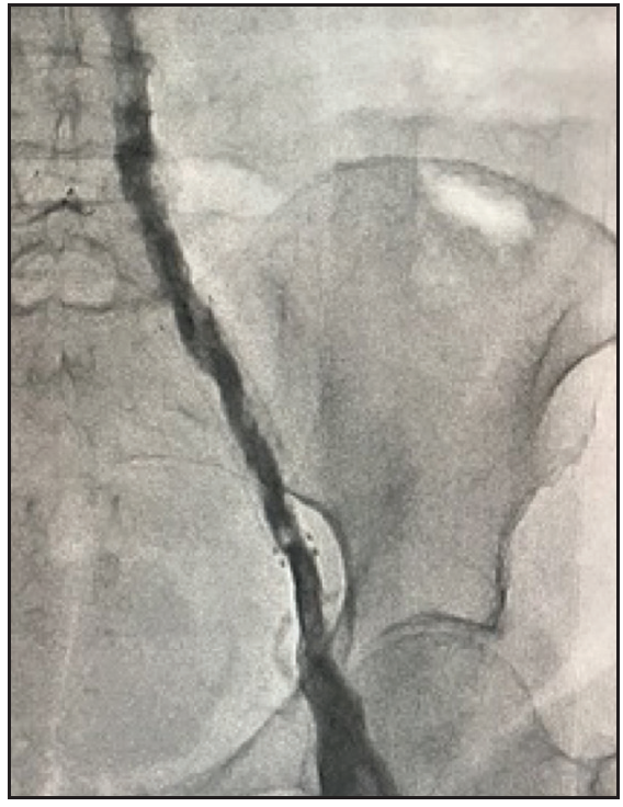 Indigo® System for Thromboembolic Disease - Endovascular Today