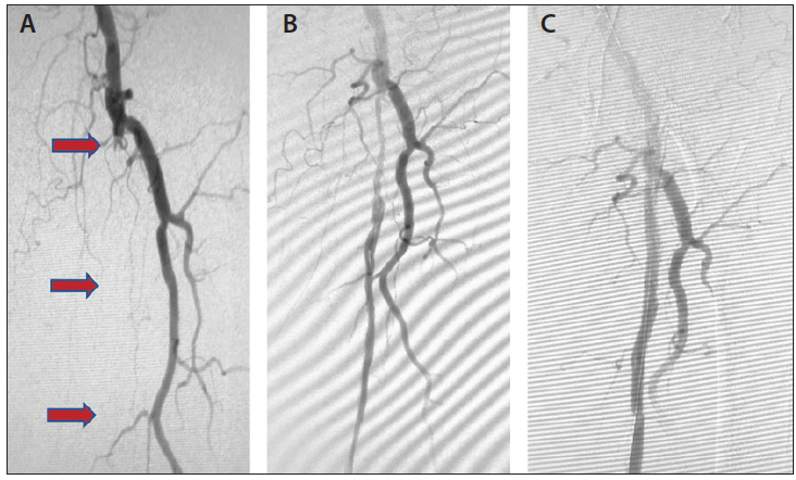 Utility of the FLEX Dynamic Scoring Catheter® in Peripheral ...