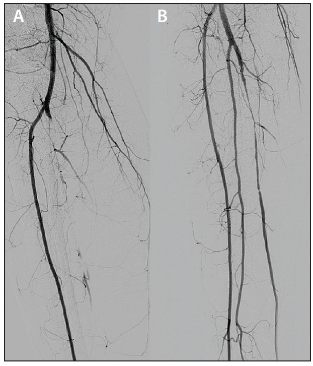 Indigo System for Thromboembolic Disease - Endovascular Today