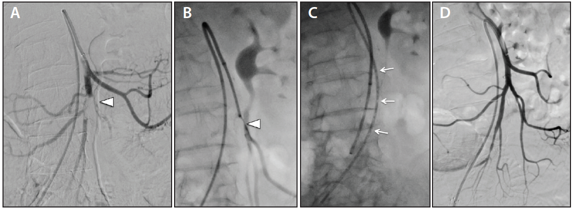 Indigo System for Thromboembolic Disease - Endovascular Today
