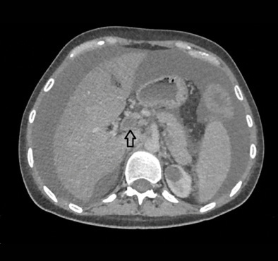 Indigo System for Thromboembolic Disease - Endovascular Today