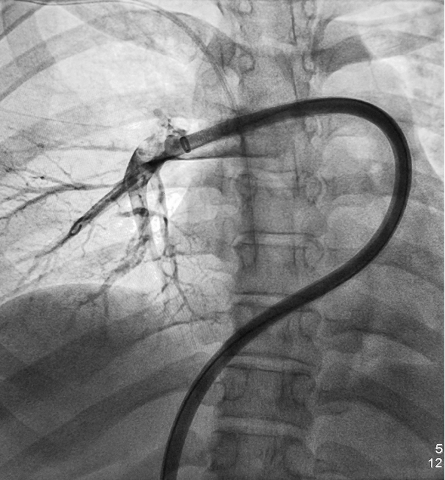 Emerging Tools for Lytic-Free, Single-Session Treatment of Venous ...