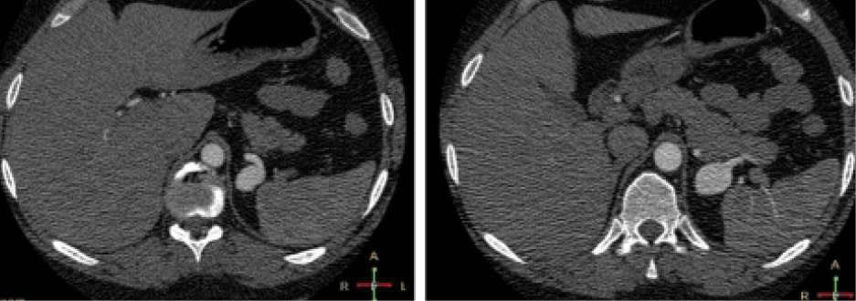 Incidental Splenic Artery Aneurysm on CT Imaging - Endovascular Today