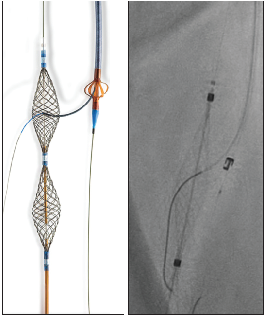 Transforming Open to Endo: Percutaneous Bypass as an Option for Long ...