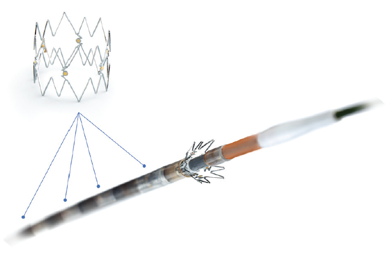 Post-PTA Dissection: Clinical Impact, Identification, and Repair ...